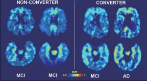 Researchers Use FDDNP–PET Scanning to Predict Cognitive Decline