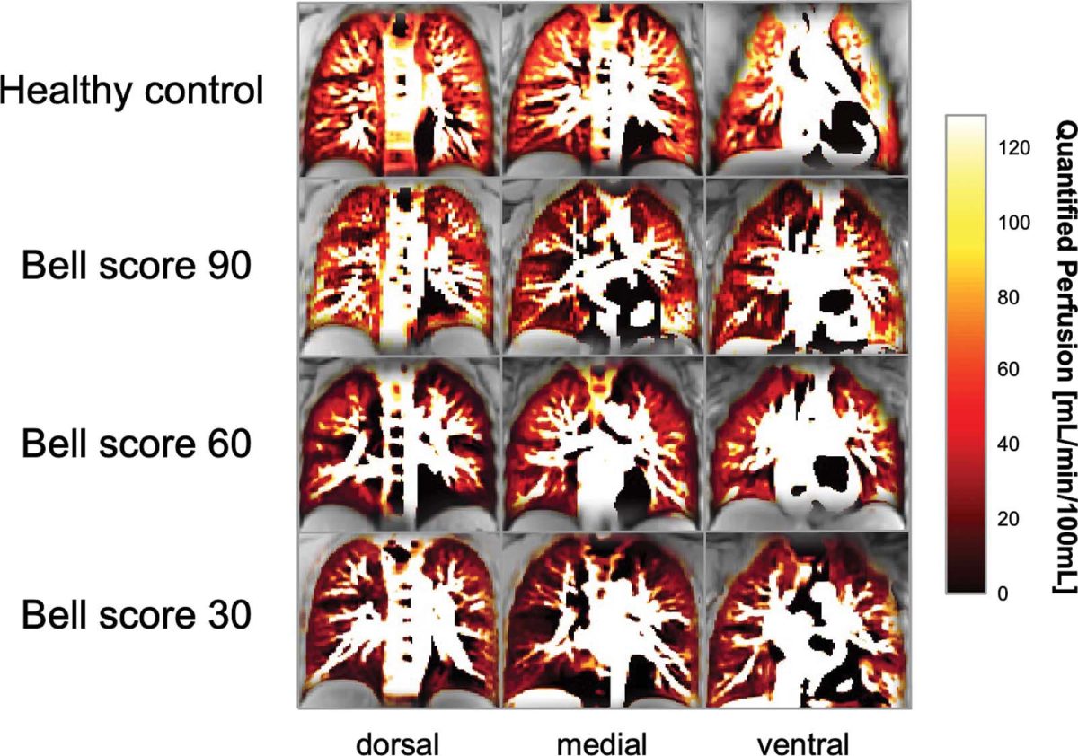New MRI Study Uncovers Hidden Lung Abnormalities in Children With Long ...