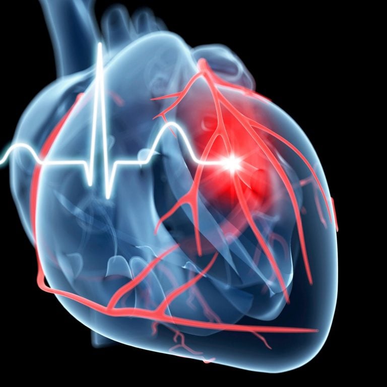 Dangerous Paradox: Physical Activity May Hasten Build-Up of Heart ...