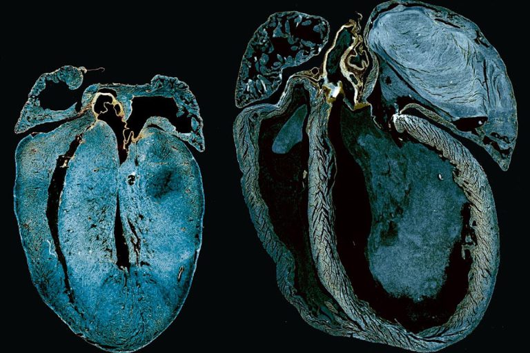 Surprising Discovery: Change in Heart Energy Production May Be Key to ...