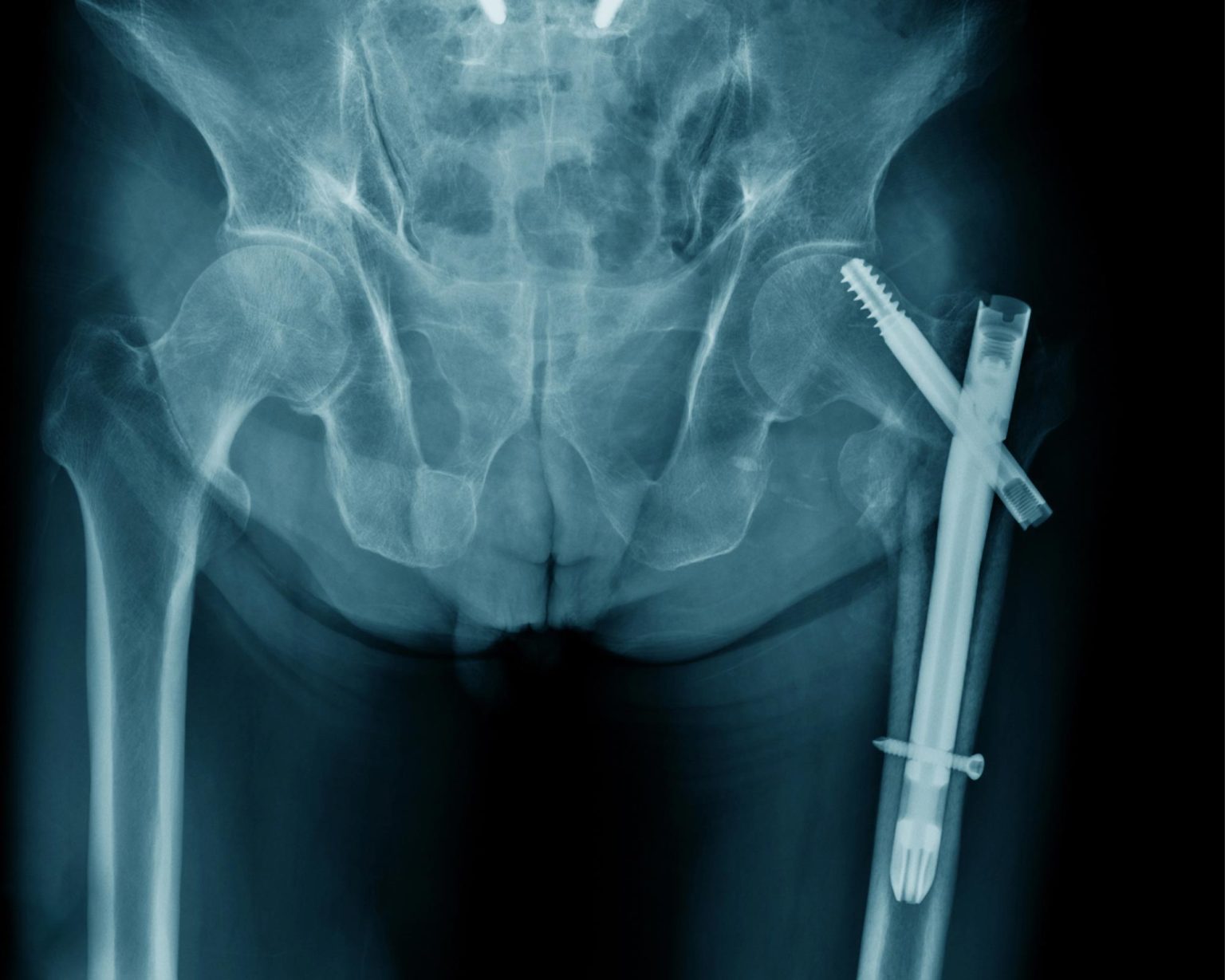 Bone Health Alarm: Study Shows 50% Increased Risk of Hip Fracture in ...