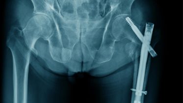 Doctors Complete Hip Surgery with 3D Printed Implant and Bone Stem Cell ...