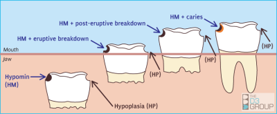 100-Year-Old Mystery of Children’s “Chalky Teeth” Explained – Affects 1 ...