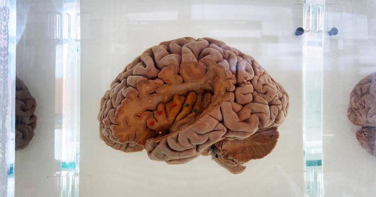 Breakthrough in Stroke Recovery: Researchers Uncover How the Brain Can ...