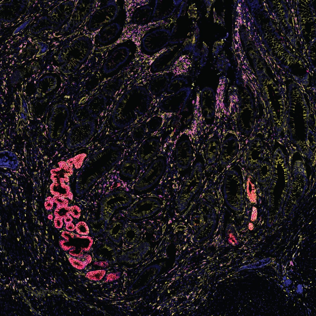 Largest Gut Cell Atlas Ever Created Reveals Hidden Links to Chronic ...