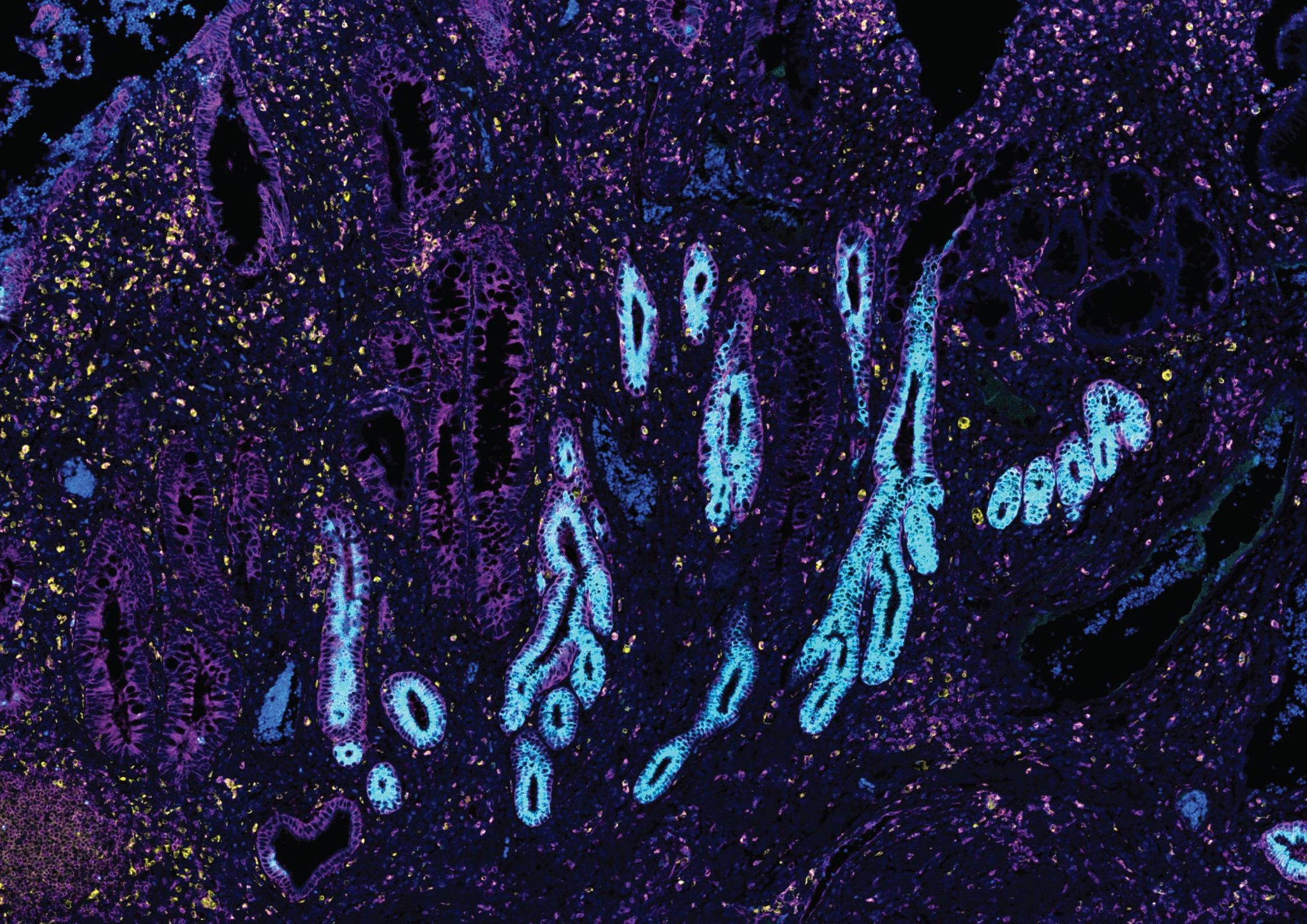 Largest Gut Cell Atlas Ever Created Reveals Hidden Links to Chronic ...