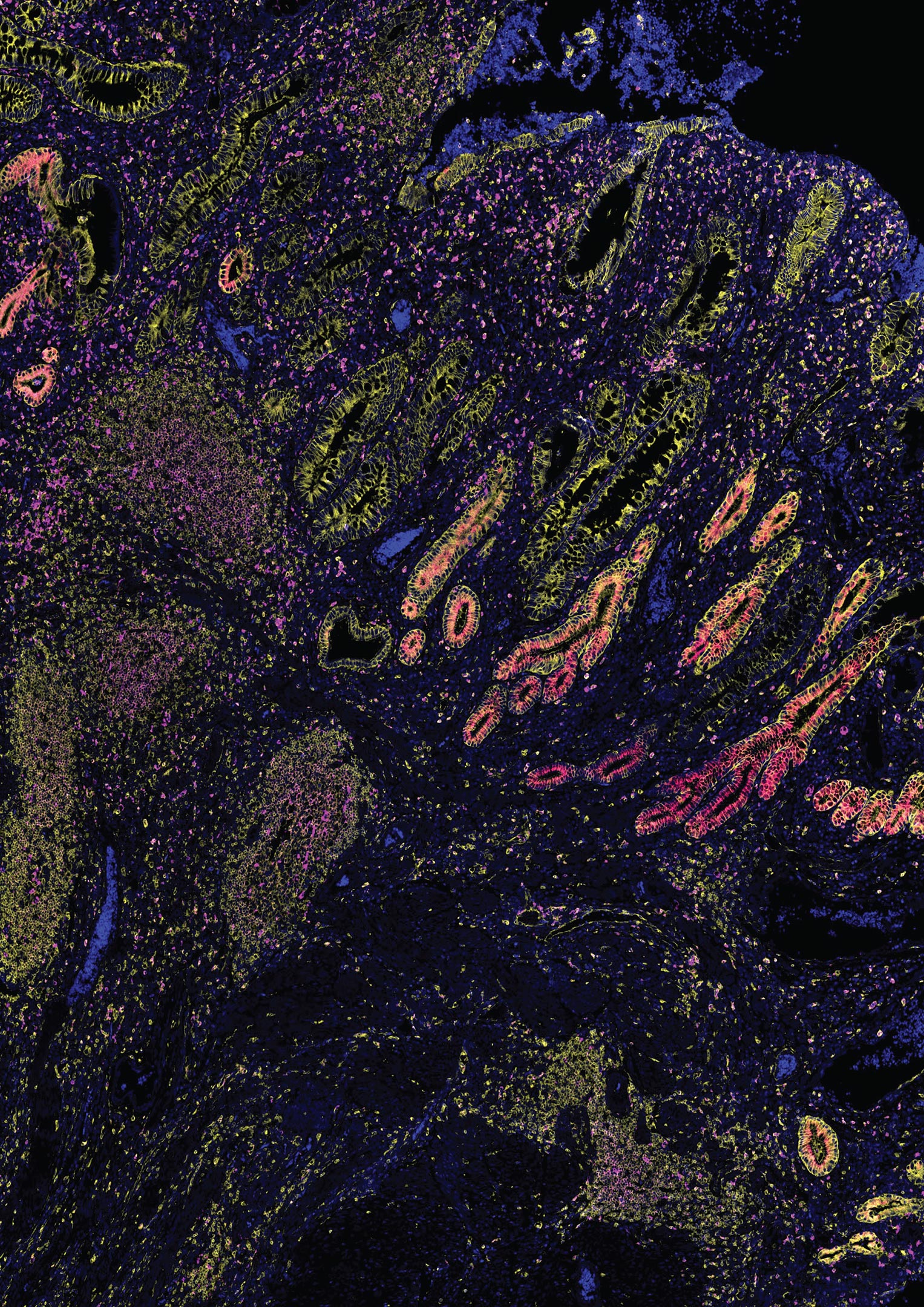 Largest Gut Cell Atlas Ever Created Reveals Hidden Links to Chronic ...