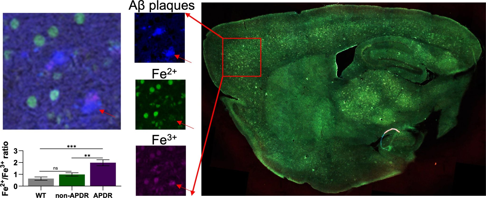 Rust in the Brain: Iron’s Surprising Role in Alzheimer’s Uncovered