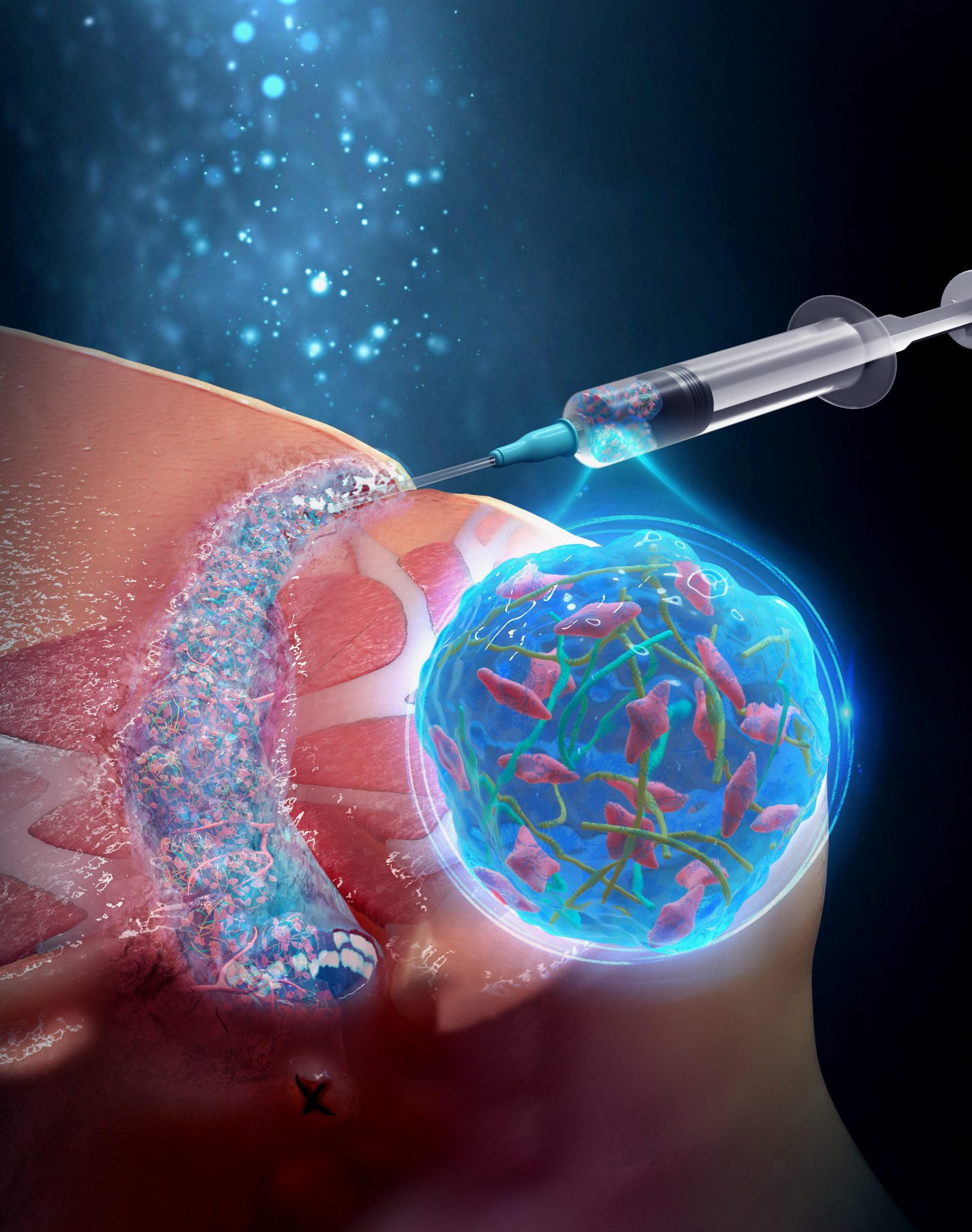 Nanofiber-Hydrogel Shows Success Treating Severe Complication of Crohn ...