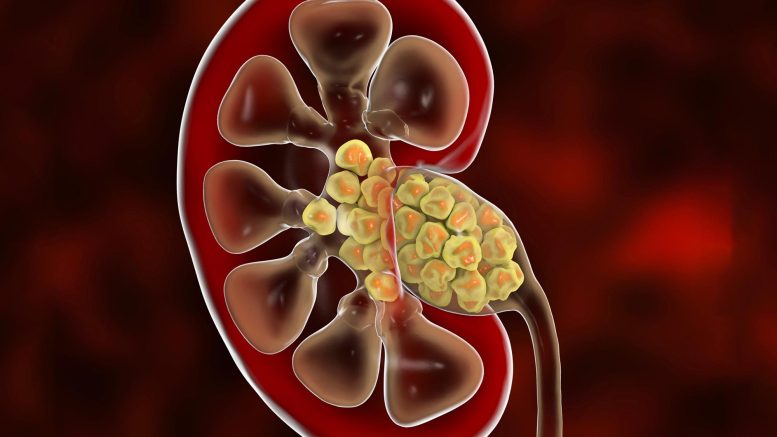Mayo Clinic Study Uncovers Dietary Trick To Help Prevent Kidney Stones