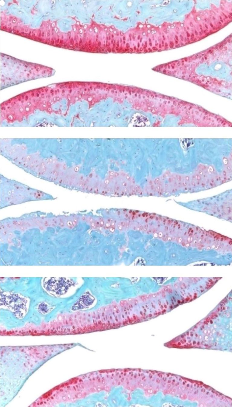 Anti-Aging Injection Regrows Knee Cartilage and Prevents Arthritis