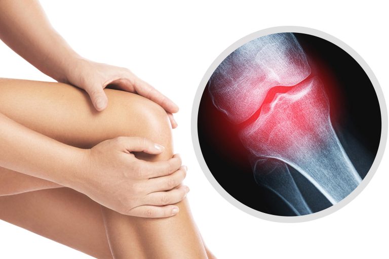 Blood Test Detects Knee Osteoarthritis 8 Years Before X-Rays