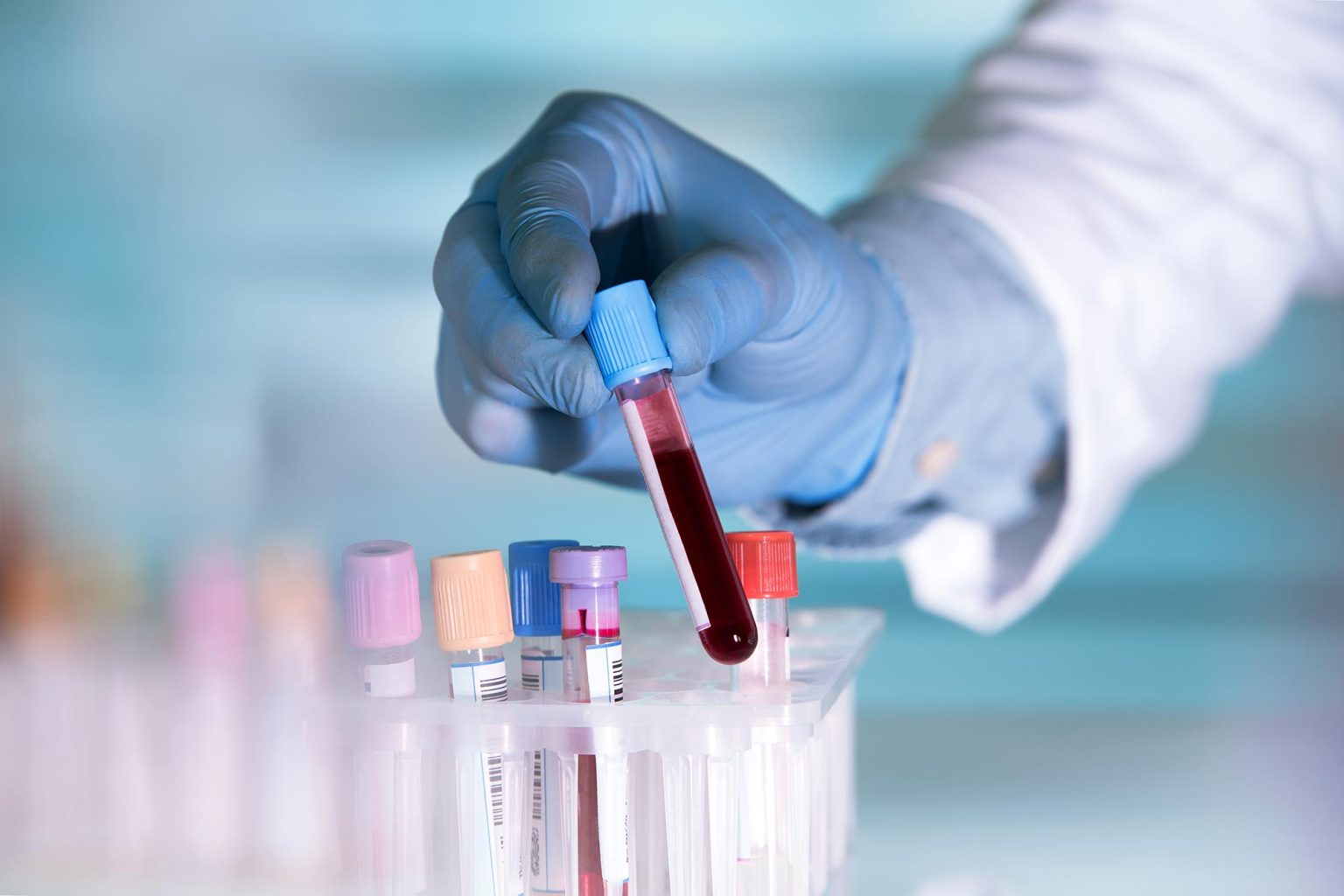 Breakthrough Blood Test Detects Head and Neck Cancer up to 10 Years ...