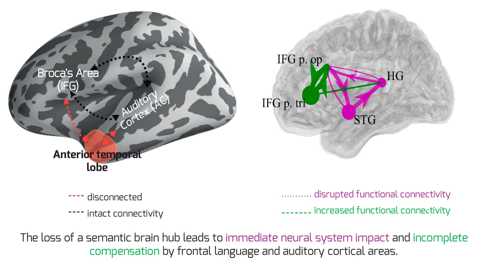La chirurgie de l'épilepsie révèle les autoroutes secrètes du cerveau ...