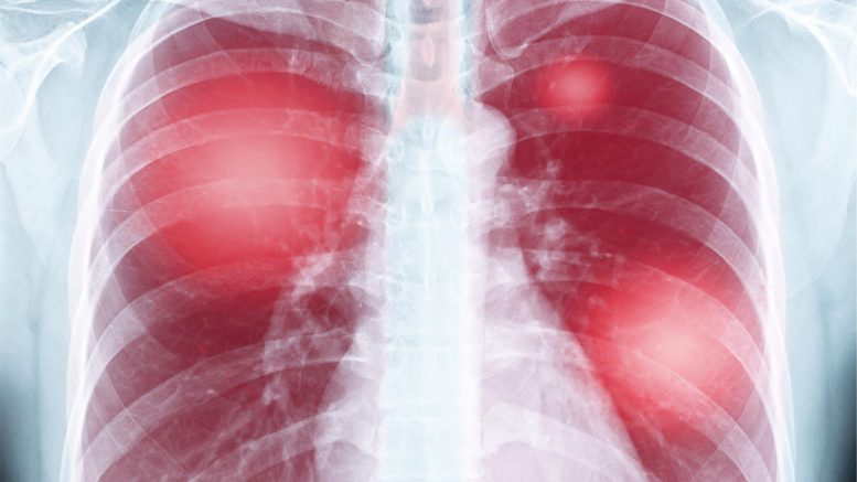 New Treatment Blocks and Reverses Pulmonary Fibrosis