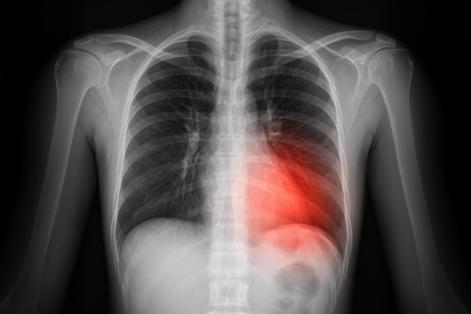 The Hidden Gene That Can Collapse Your Lung – And It’s 100x More Common ...