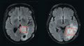MR Spectroscopy Helps Measure Brain Tumor Mutation