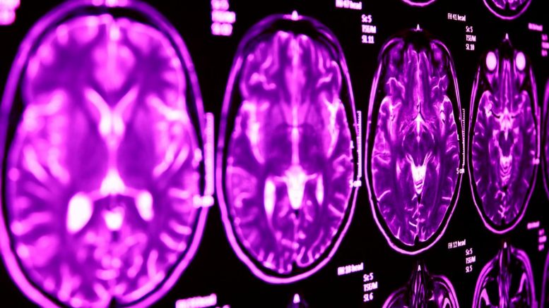 New Research Shows How Ketamine Acts As “Switch” in the Brain