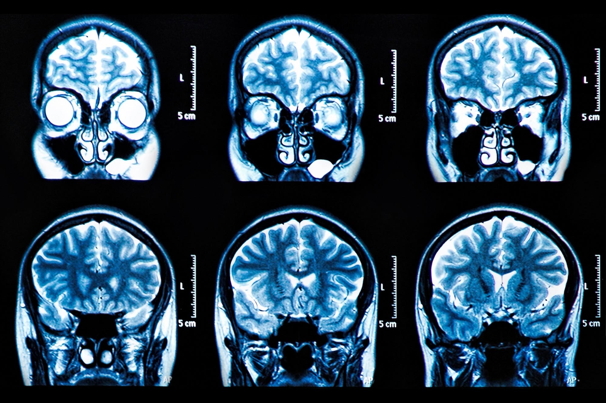 Brain Activation Patterns In Medicated Versus 52 OFF