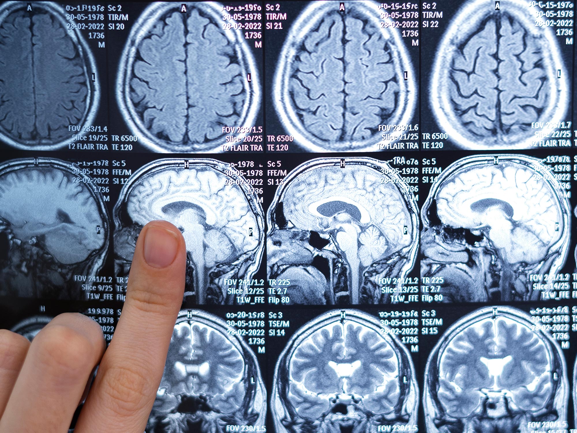 Breakthrough In Glioma Treatment New Drug Delays Progression Of Deadly