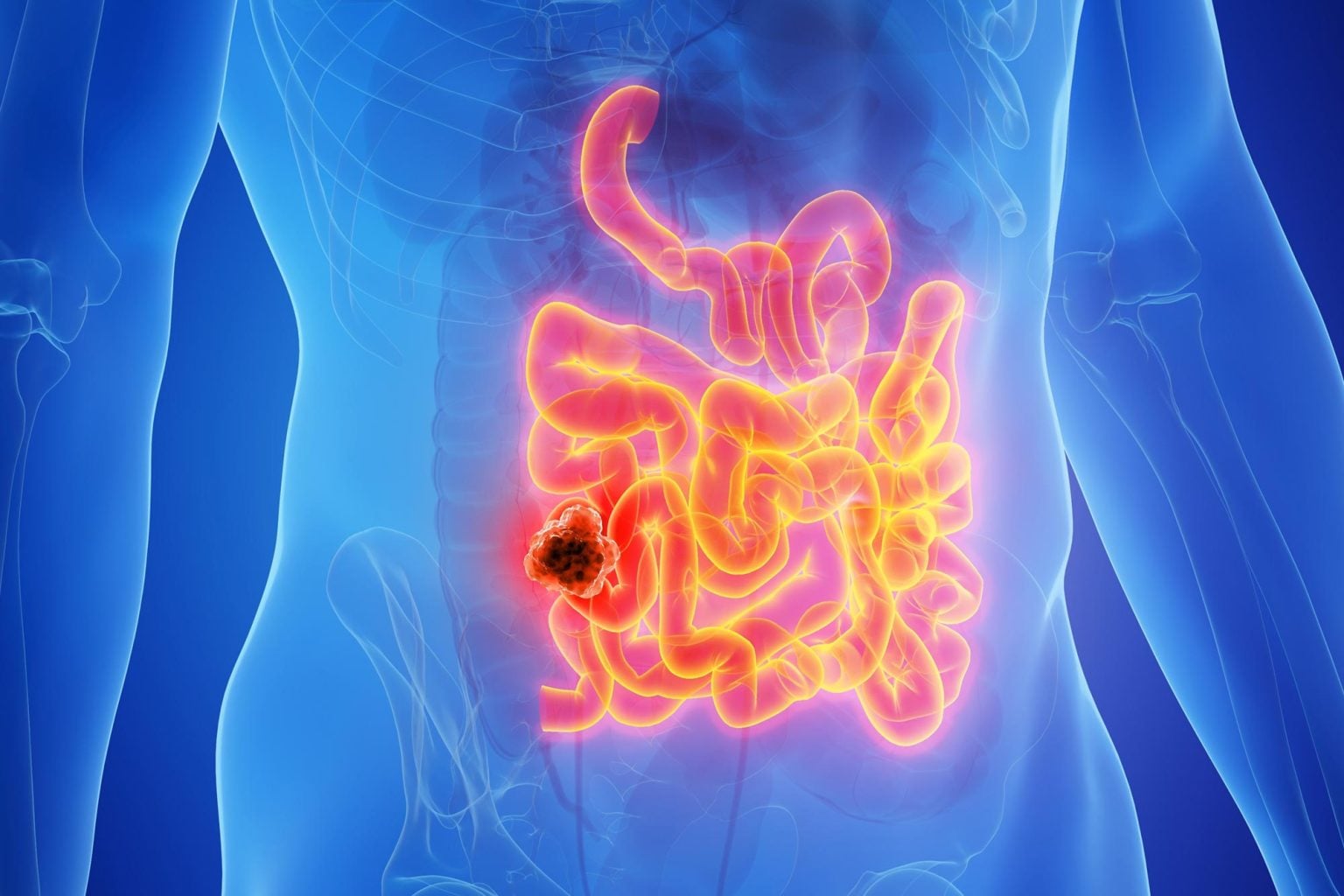 Breakthrough Bowel Cancer Trial Leaves Patients Cancer Free For Nearly