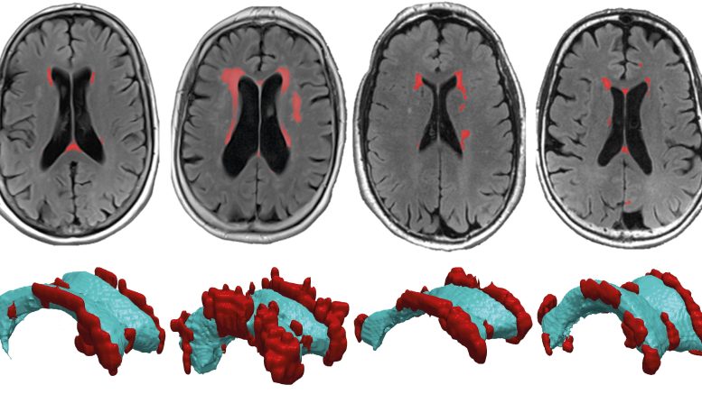 Rare ALK Genetic Mutation Extends Cancer Survival