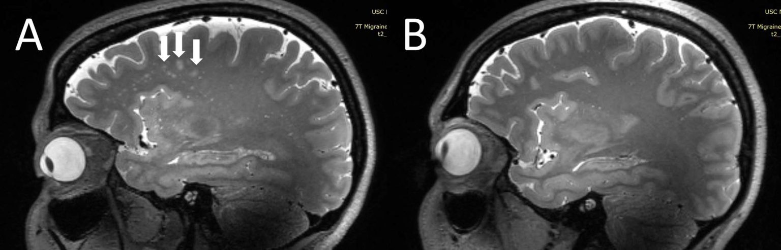 Revolutionary MRI Technology Uncovers Stunning Brain Changes in ...