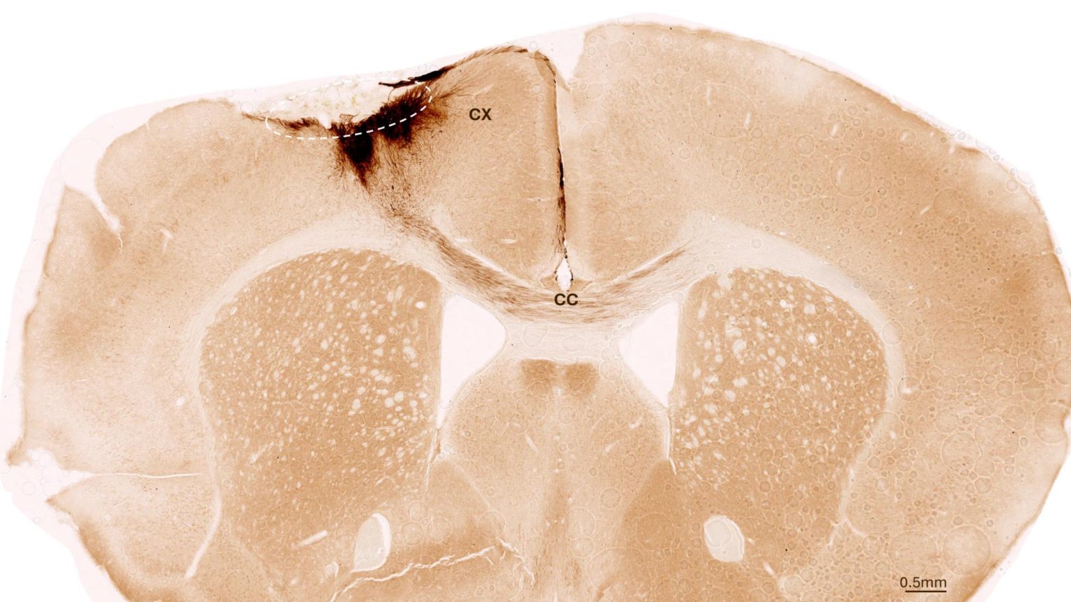 Stroke Damage Reversed As Stem Cells Regrow the Brain