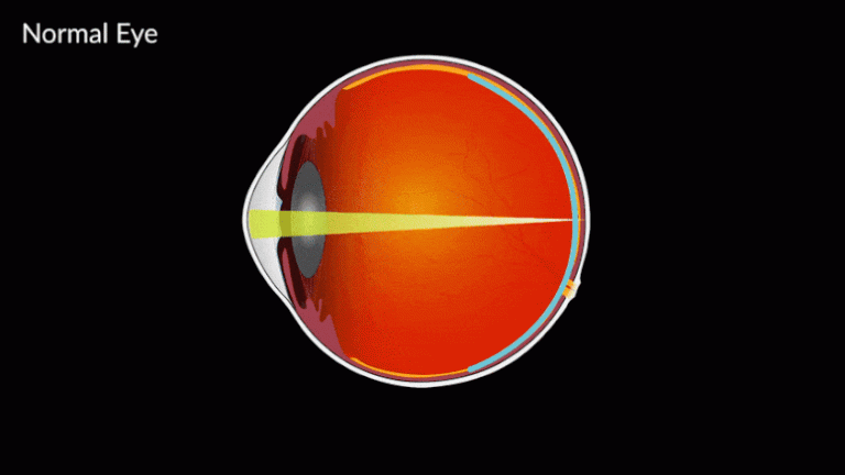 Engineers Develop a Telescopic Contact Lens