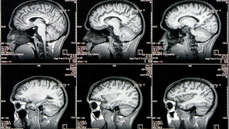 Key Areas of the Brain Develop Differently in Adolescents with Bipolar ...