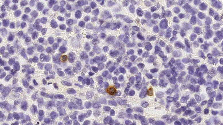 Fat “Shield” Protects Natural Killer Immune Cells – and Some Cancers ...