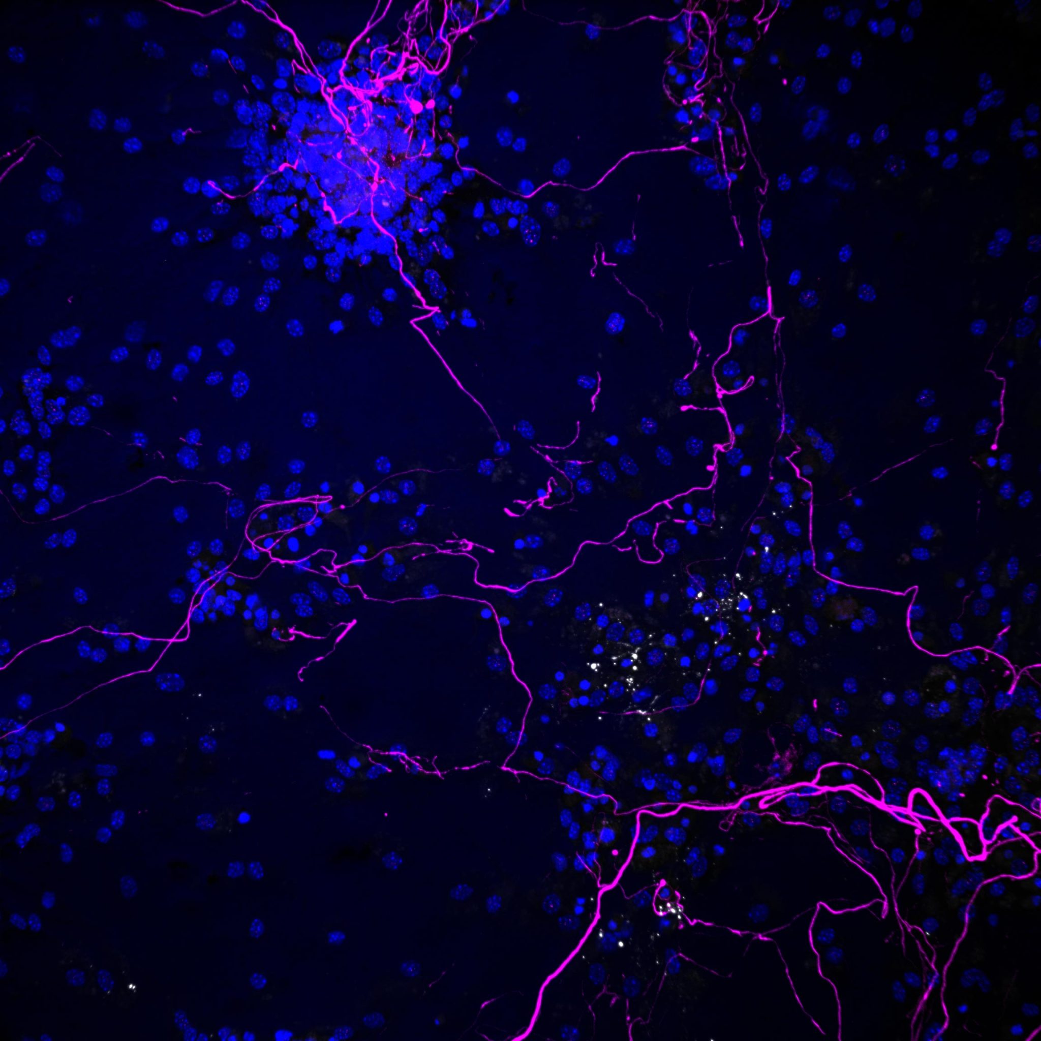 Alzheimer’s Puzzle Piece Found: The Inflammatory Trigger That May ...