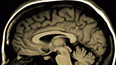 Parkinson's Disease News - Page 5 of 5 - SciTechDaily