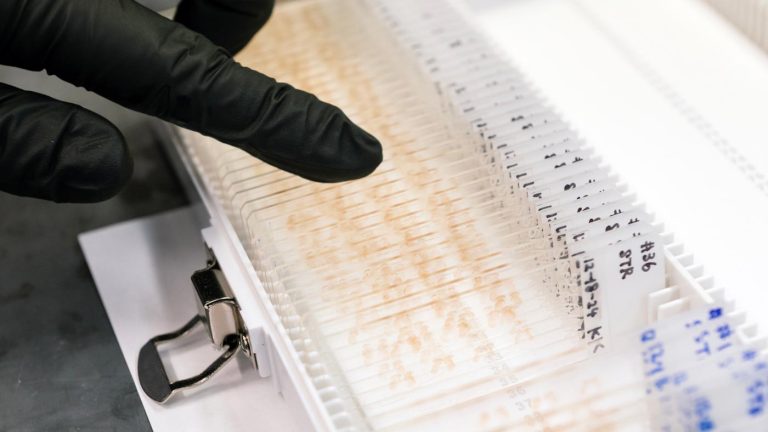 Overworked Brain Cells May Hold the Key to Parkinson’s
