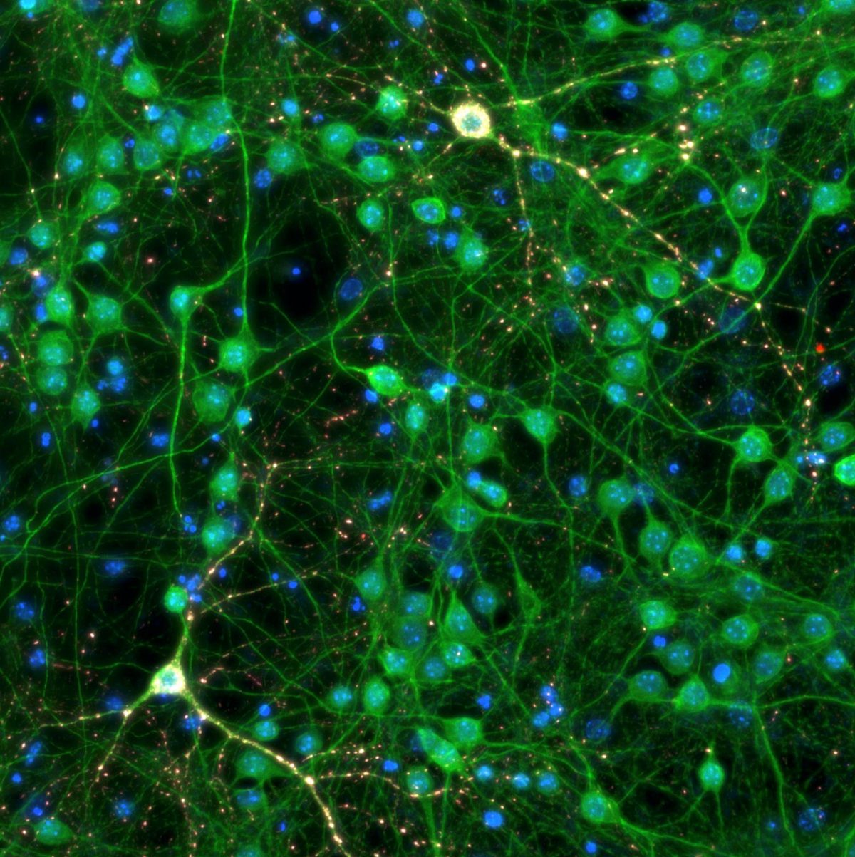Promising New Alzheimer’s Treatment Eradicates Tau Tangles