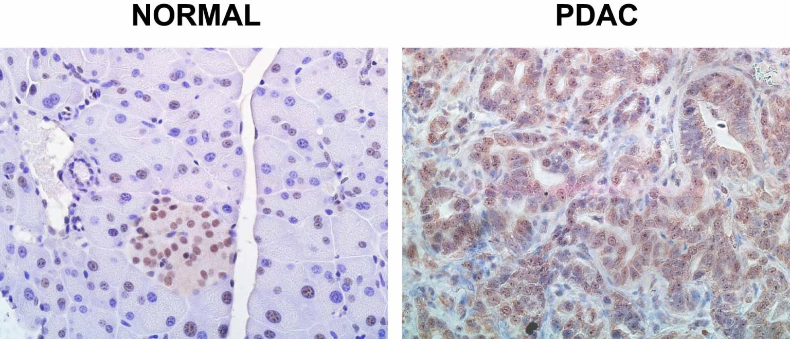 Cancro al pancreas: attenzione a questa proteina killer - MediMagazine