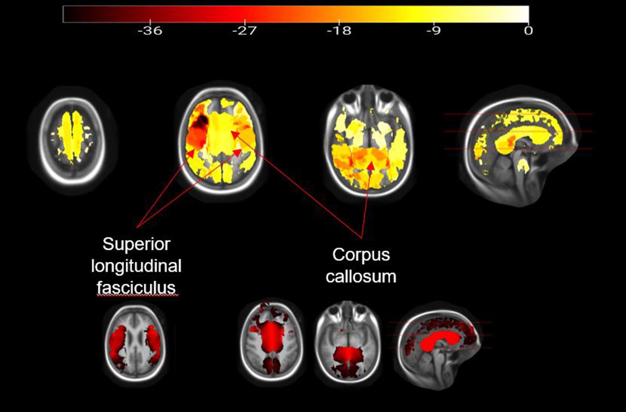 The Unseen Effects of Childhood Obesity: New Research Finds Connection ...