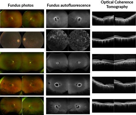 NIH Scientists Discover Gene Responsible for Rare Eye Disease