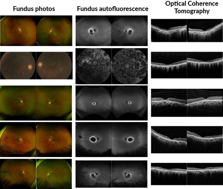 NIH Scientists Discover Gene Responsible for Rare Eye Disease