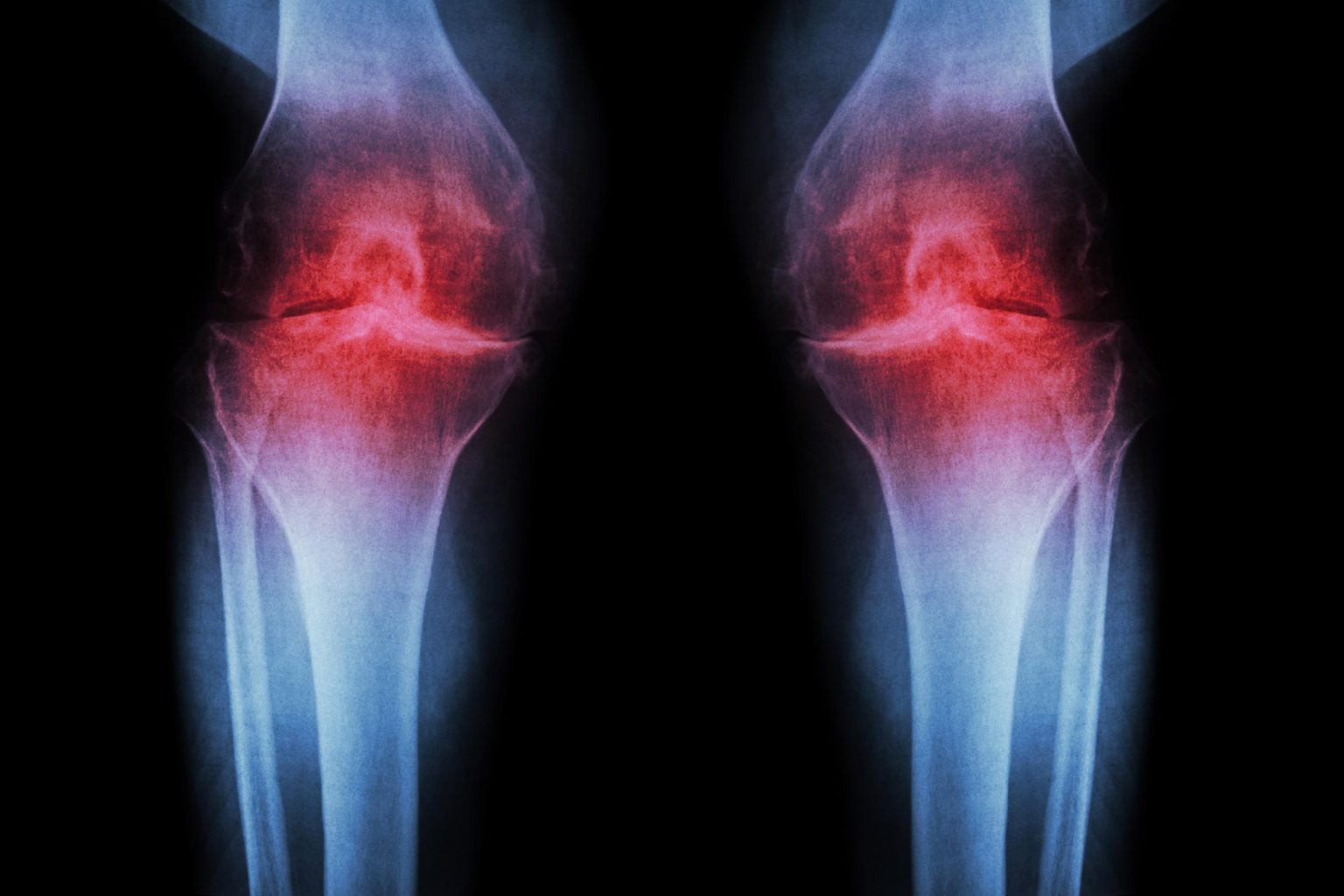 Anti-Aging Injection Regrows Knee Cartilage and Prevents Arthritis