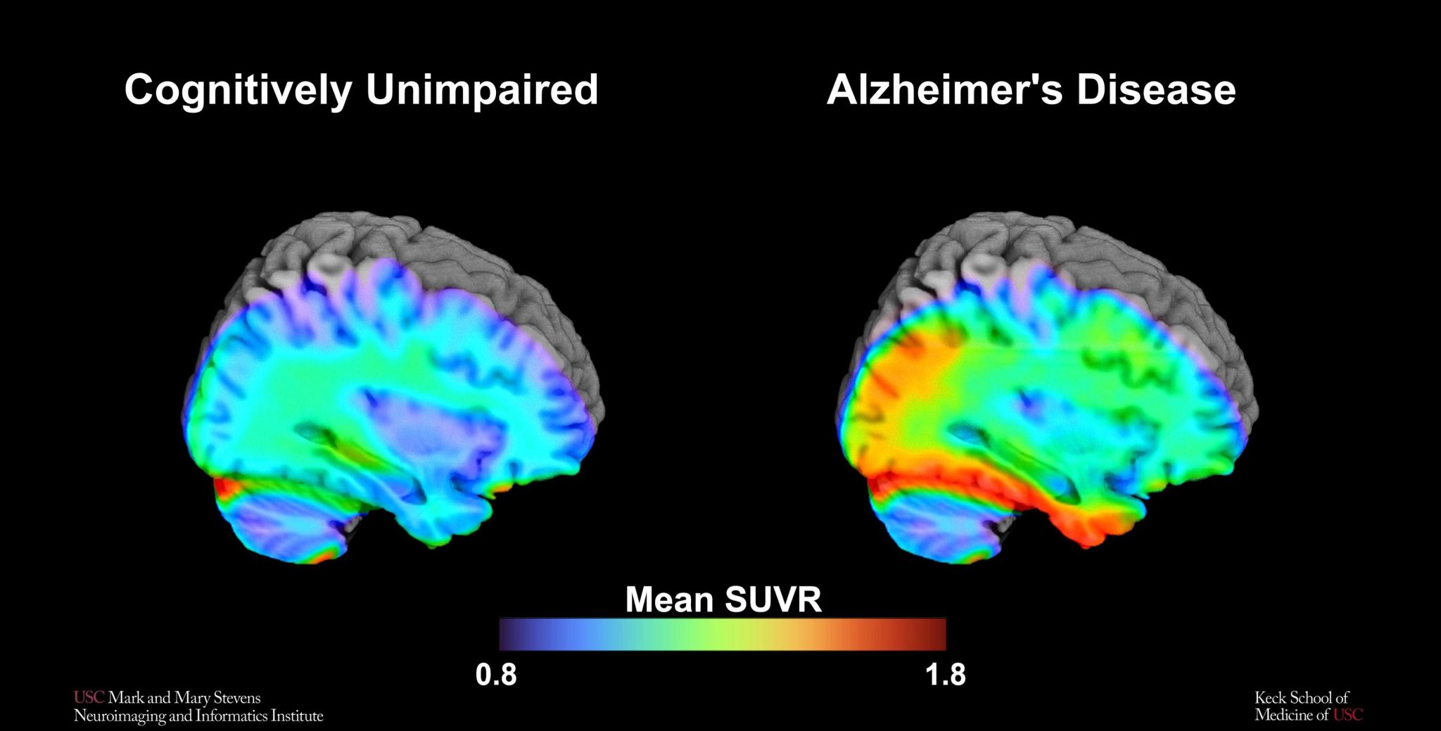 This Tau Brain Scan Could Predict Alzheimer’s Early