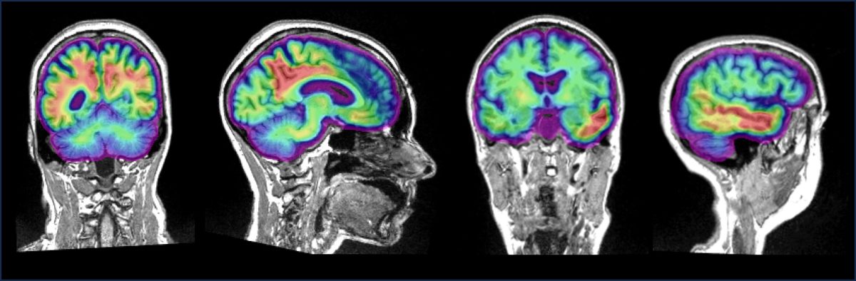 Unlocking How Amyloid and Tau Proteins Drive Brain Changes Before ...