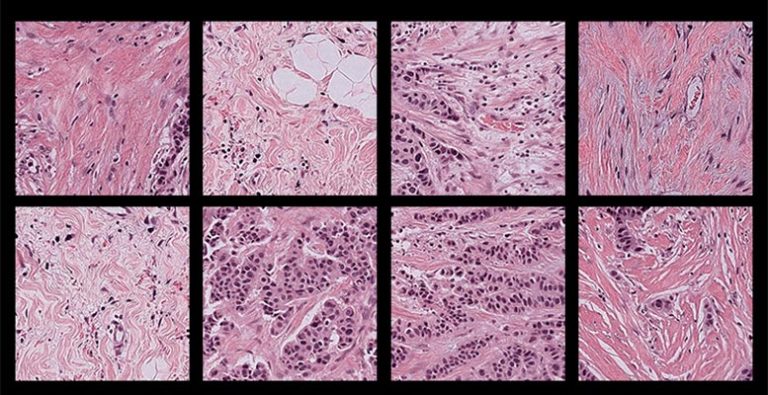 What AI Learned From Cancer Slides Shocked Researchers