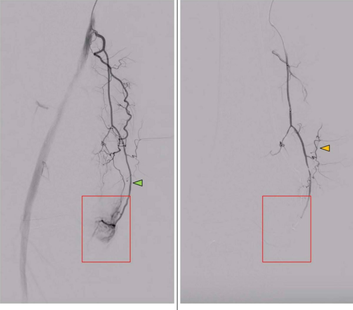 Revolutionary Pain Alleviation: Minimally Invasive Procedure Relieves ...
