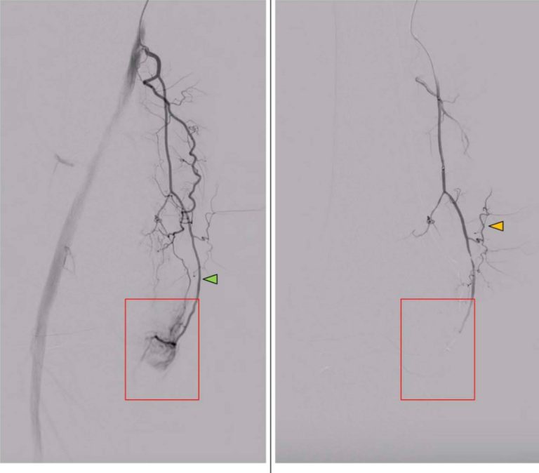 Revolutionary Pain Alleviation: Minimally Invasive Procedure Relieves ...