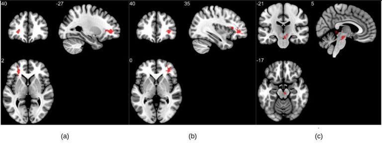 Significant Post-COVID Brain Abnormalities Revealed by Special MRI