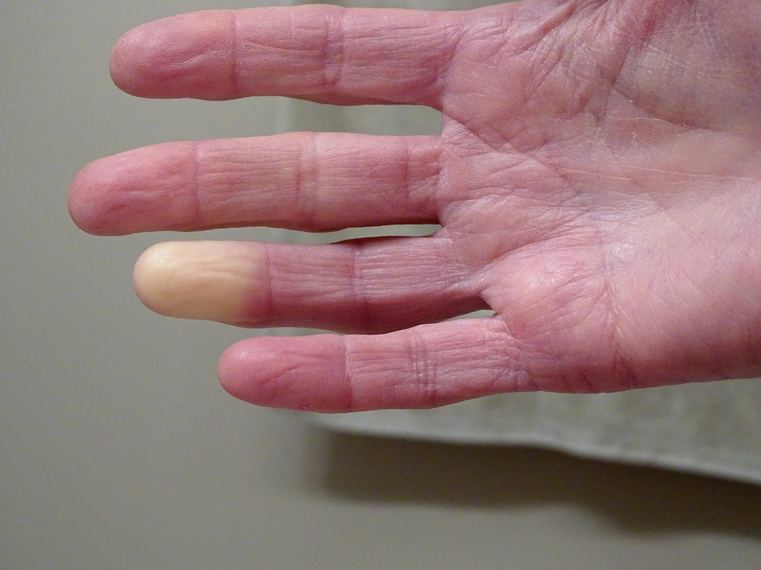 Cold Case Solved: Raynaud’s Mystery Solved With New Genetic Findings