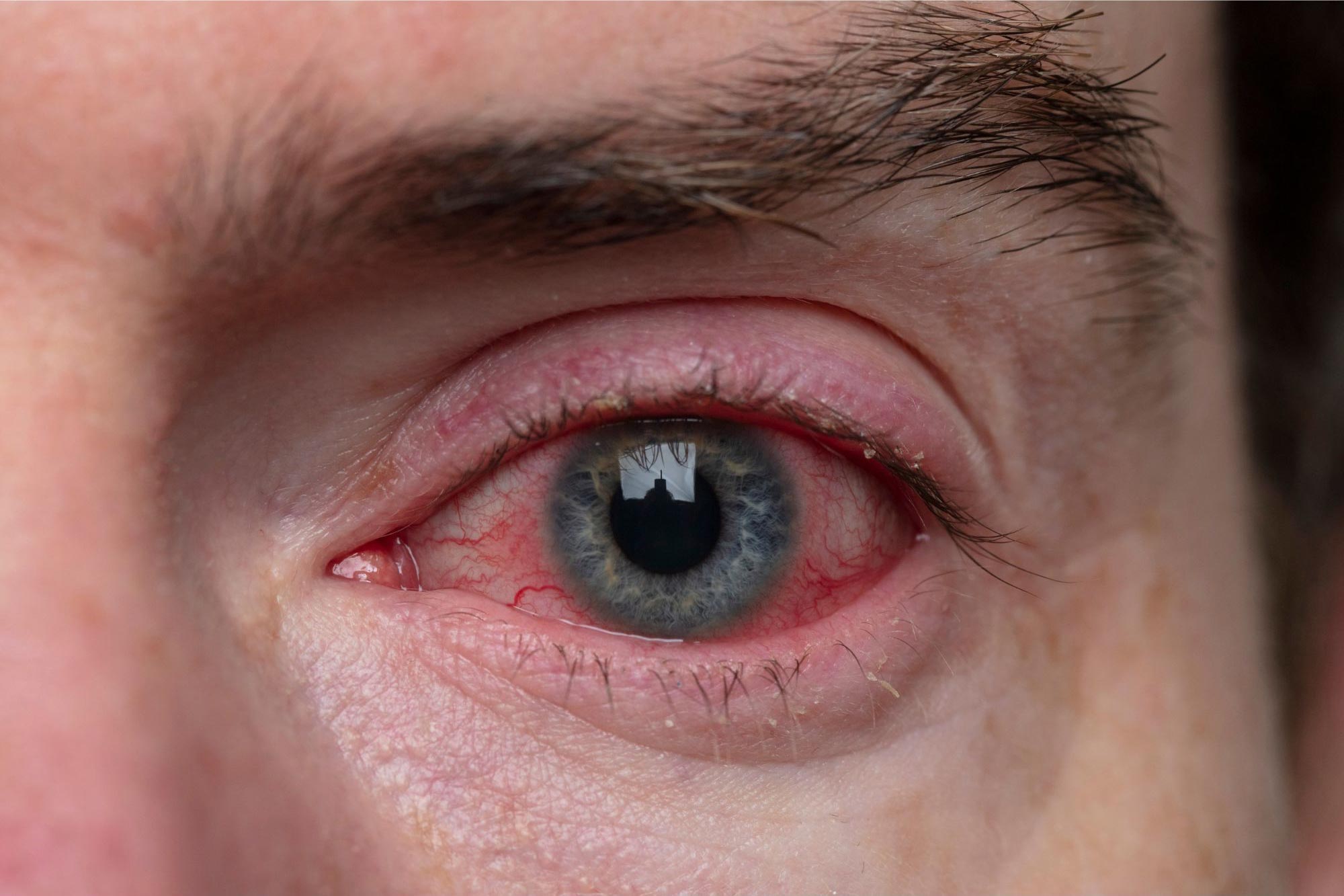 Scientists Unveil Safer Way To Treat Inflammatory Eye Diseases