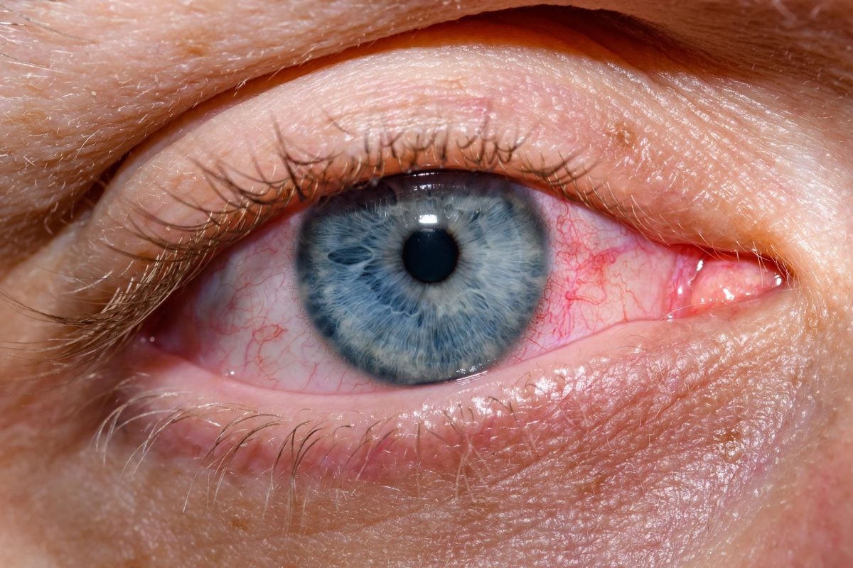 Scientists Develop Experimental Eye Drop That Could Transform Dry Eye ...