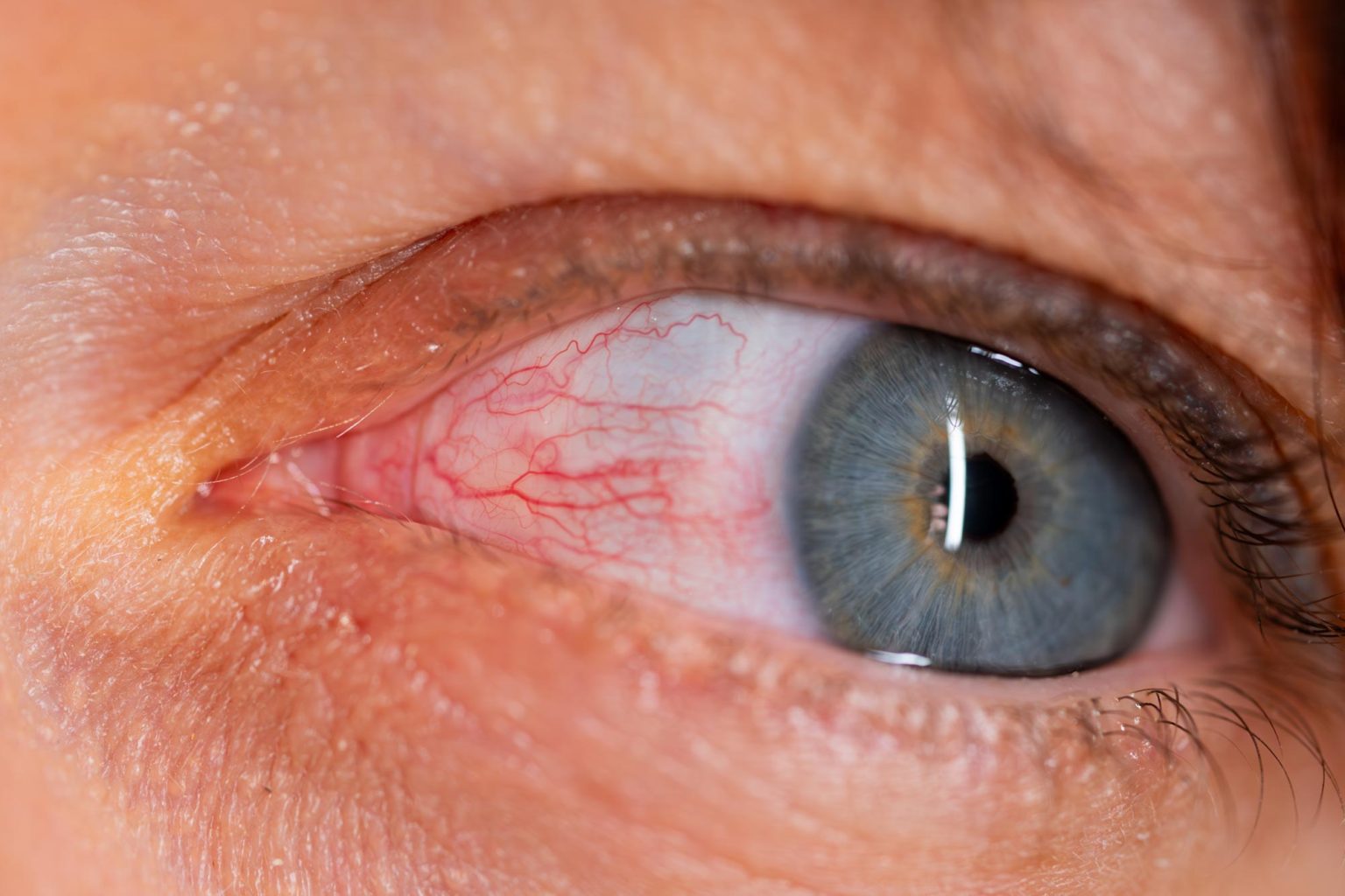 Common Bacteria Found in the Eye Linked to Alzheimer’s Disease